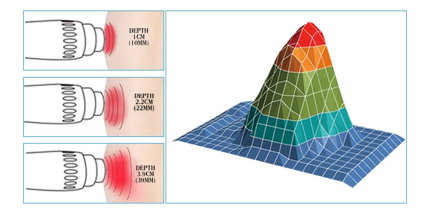 Home Use Shock Wave Machine for Erectile Dysfunction