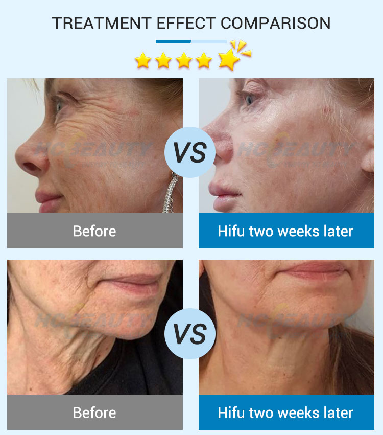 Hifu Machine 7d Face And Body